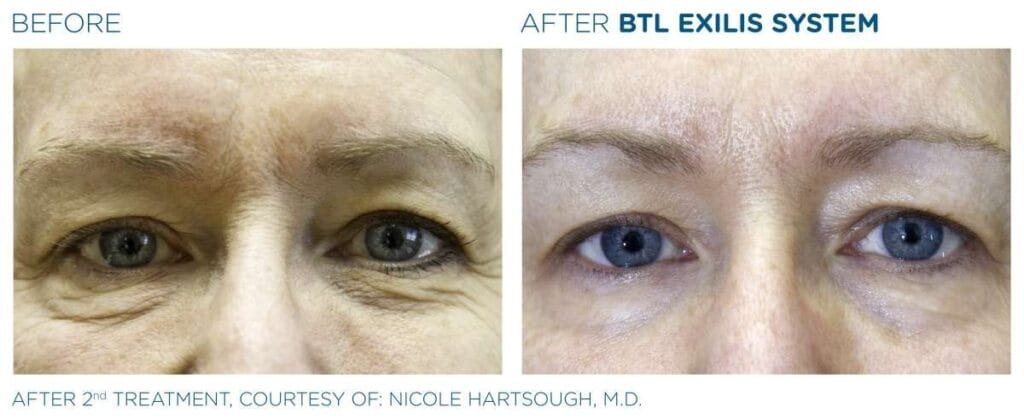 EXILIS ULTRA 360 - Effective Body Contouring Treatment
