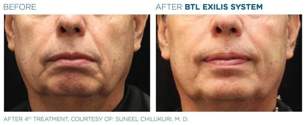 EXILIS ULTRA 360 - Aura Aesthetics Clinic